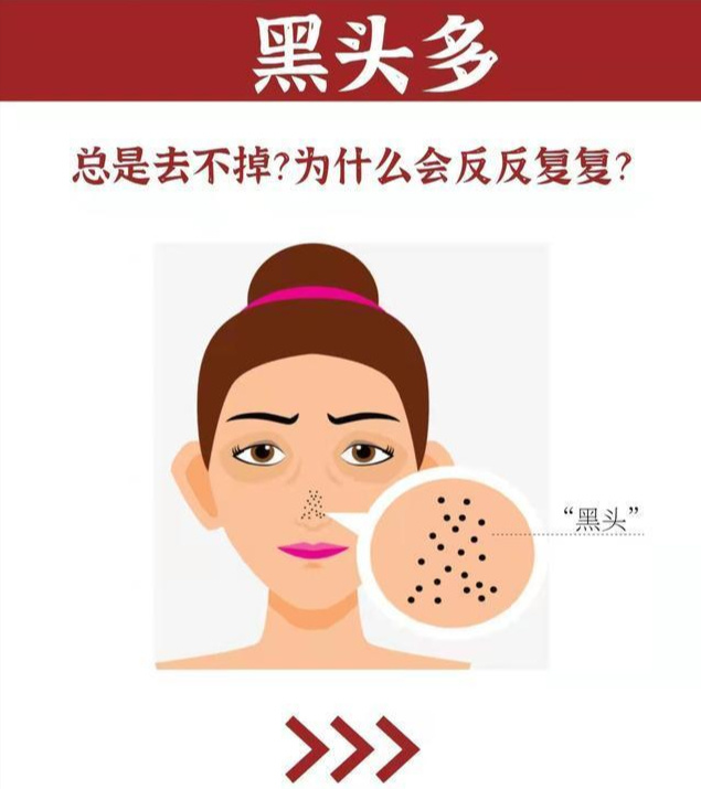 怎么去掉黑头?西安美莱教你正确处理黑头的方法 哔哩哔哩