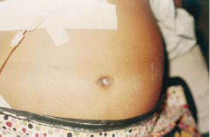 耳熟能详的 Cullen 征和 Grey-Turner 征，不止见于急性胰腺炎 - 哔哩哔哩