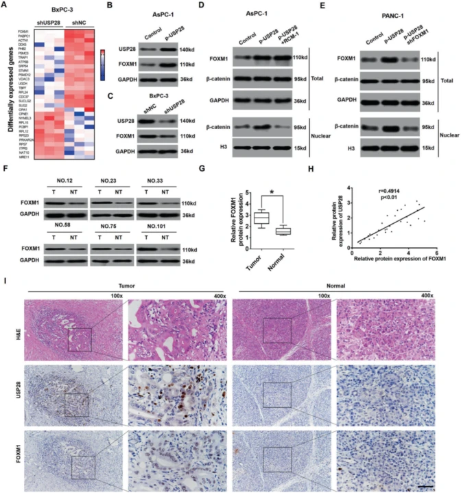 USP28通过稳定FOXM1激活Wnt、β-catenin通路促进胰腺癌进展 - 哔哩哔哩