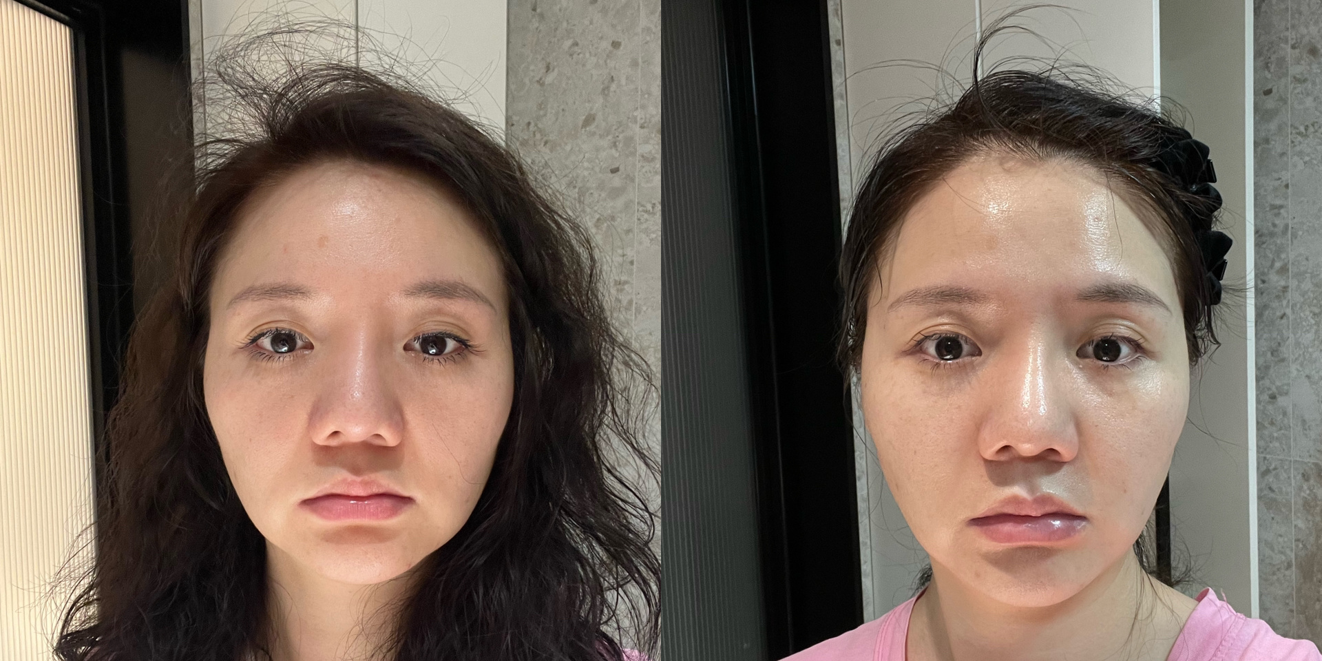 超声炮后30天效果,超声炮术后护理和注意事项 哔哩哔哩
