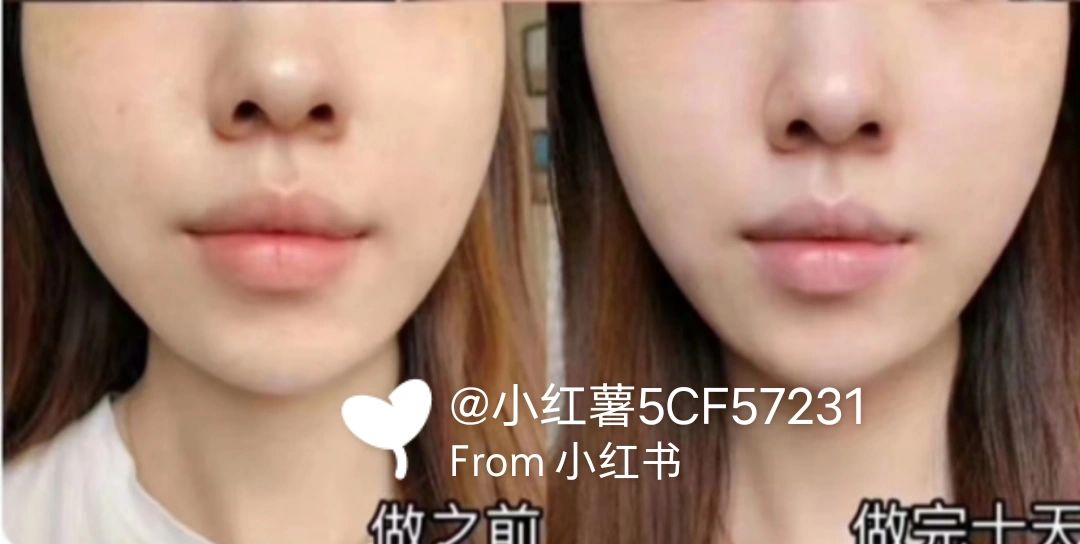 超声炮多久效果最好,超声炮术后护理和注意事项 哔哩哔哩