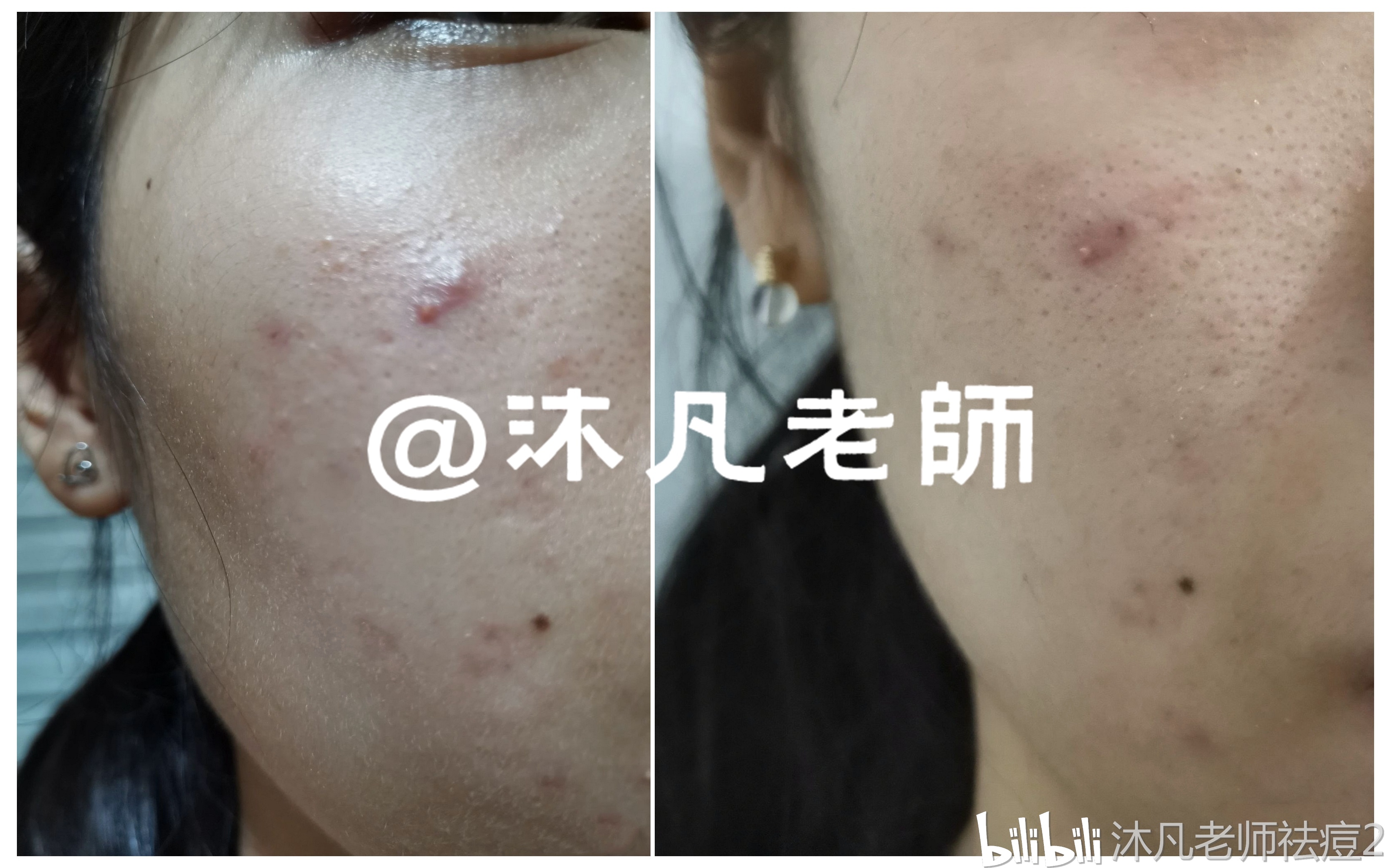 药店去痘痘的6种药膏，祛痘药膏排行榜10强 哔哩哔哩