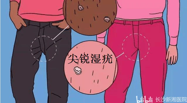 长沙新湘医院:尖锐湿疣治疗期间注意事项有哪些? 哔哩哔哩