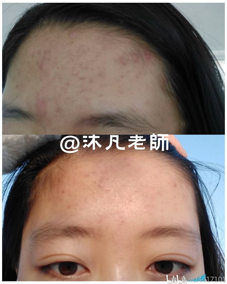 祛痘粉刺丘疹的药哪个好，丘疹型痘印怎么祛 哔哩哔哩