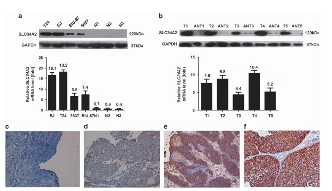 一文全解|SLC34A2（NaPi2b）为何成为多种癌症的精准治疗靶点？ - 哔哩哔哩