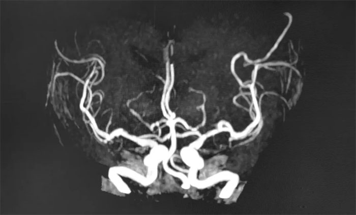 脑血管病做什么检查？专家解读：CTA、MRA、DSA - 哔哩哔哩