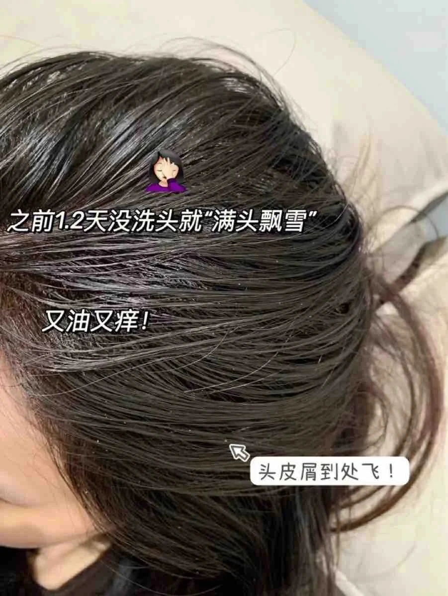 去屑止痒用什么洗发水效果好？选对洗发水解决问题 - 哔哩哔哩
