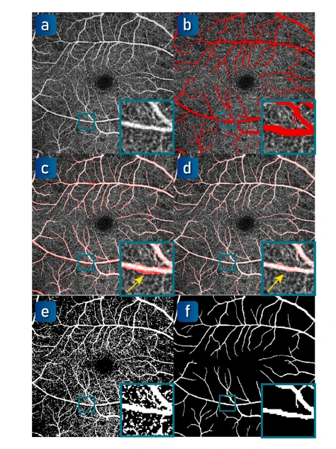 OCTA-500：用于光学相干断层扫描血管造影研究的视网膜数据集|文献速递 - 哔哩哔哩
