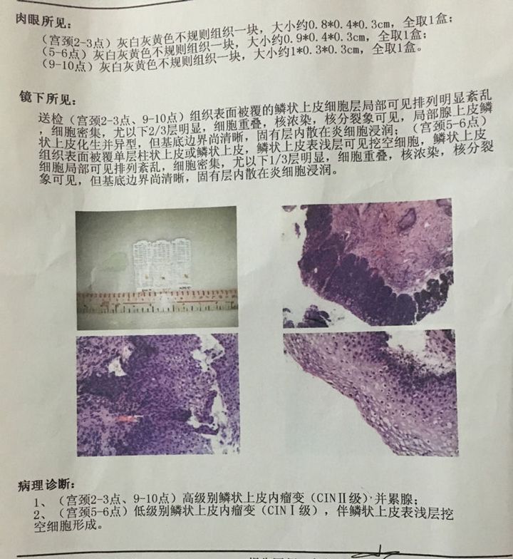 广州蕙心医院治疗hpv案例:可怕!hpv感染仅仅一年的时间就发生了宫颈病变 哔哩哔哩