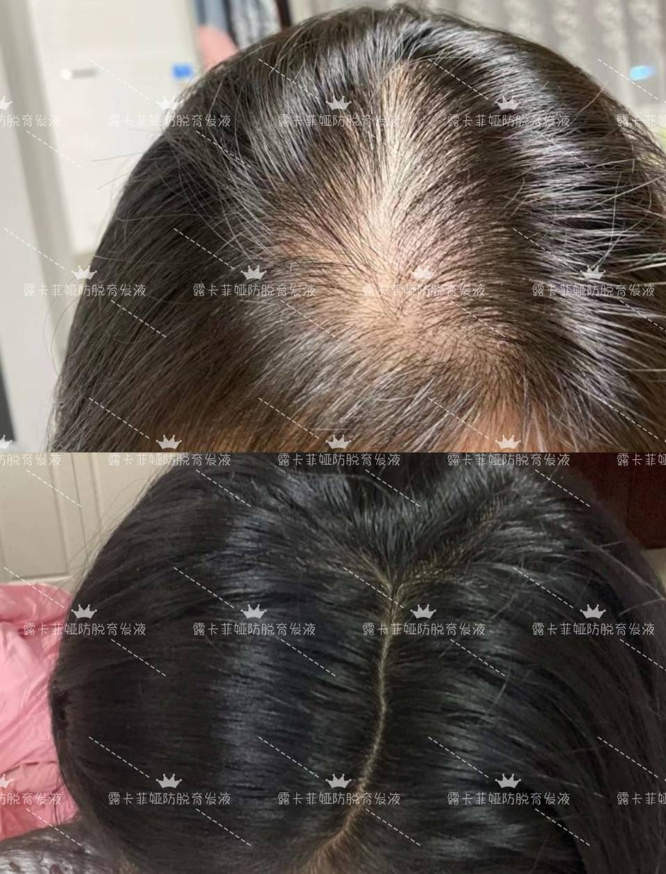 世界公认有效防脱生发牌子前10强：已排雷放心挑！ - 哔哩哔哩