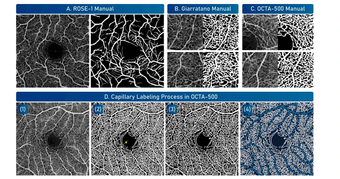 OCTA-500：用于光学相干断层扫描血管造影研究的视网膜数据集|文献速递 - 哔哩哔哩