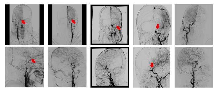 CVFSNet：一种用于端到端脑梗塞溶栓治疗后改良脑梗死溶栓分级（mTICI） - 哔哩哔哩