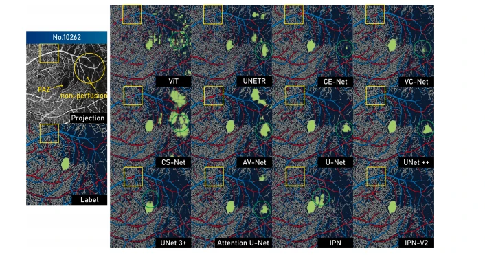 OCTA-500：用于光学相干断层扫描血管造影研究的视网膜数据集|文献速递 - 哔哩哔哩