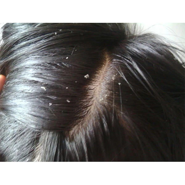 止痒去屑的洗发水哪个好？止痒去屑洗发水推荐 - 哔哩哔哩