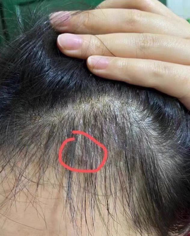 头皮干燥头屑多用什么洗发水?控油去屑好的洗发水排行 - 哔哩哔哩