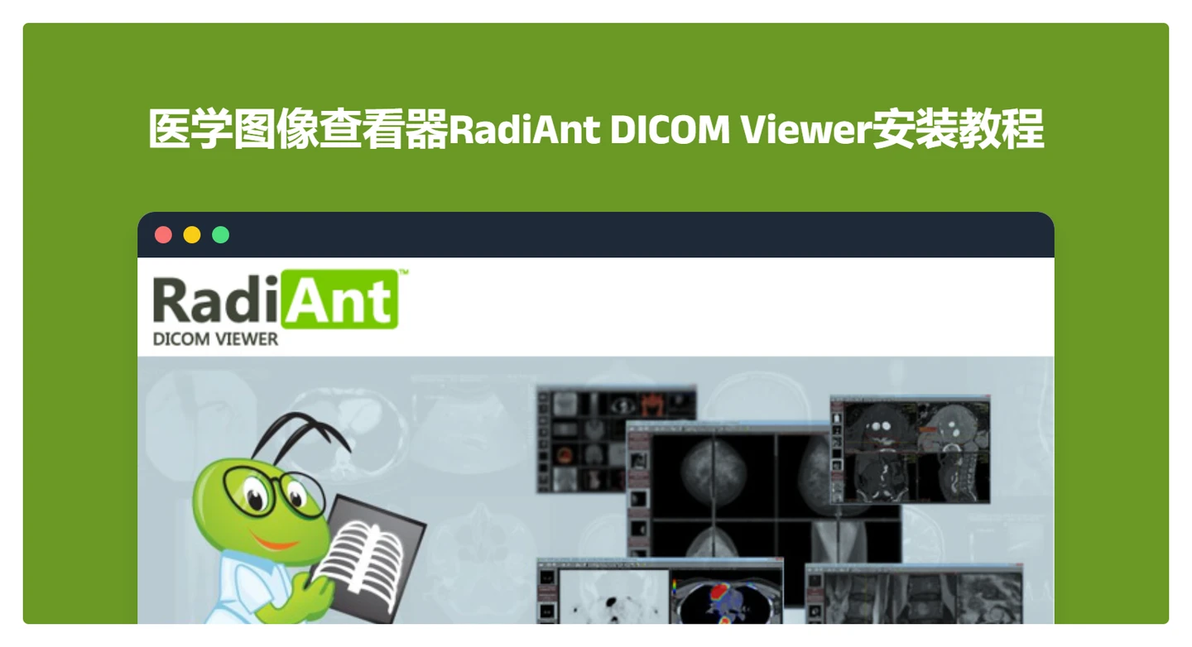 医学图像查看器RadiAnt DICOM Viewer安装教程，附安装包 - 哔哩哔哩