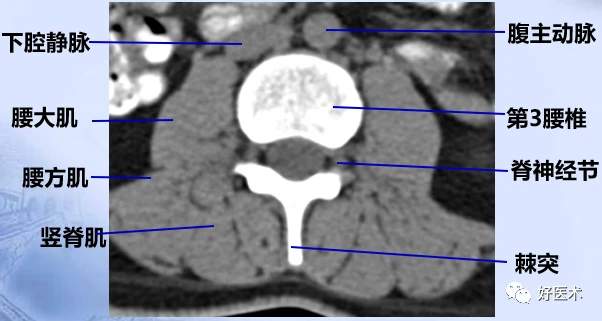 腰椎CT阅片技巧速记手册，收藏随时对照查看！ - 哔哩哔哩