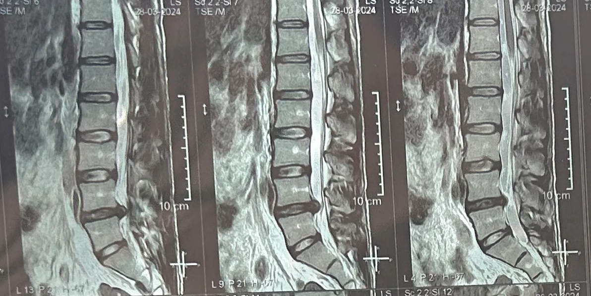 椎间盘退行性变的Pfirrmann分级标准 - 哔哩哔哩