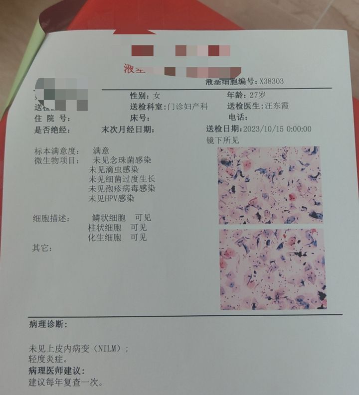 广州蕙心医院治疗hpv案例:可怕!hpv感染仅仅一年的时间就发生了宫颈病变 哔哩哔哩