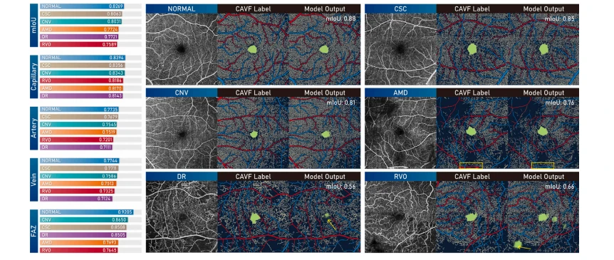 OCTA-500：用于光学相干断层扫描血管造影研究的视网膜数据集|文献速递 - 哔哩哔哩