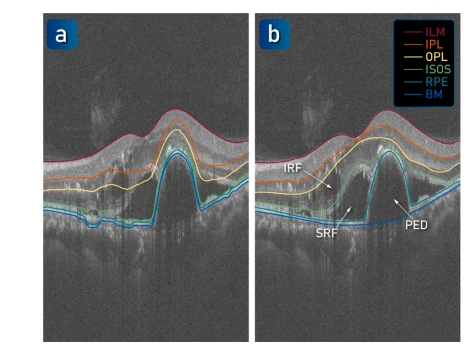 OCTA-500：用于光学相干断层扫描血管造影研究的视网膜数据集|文献速递 - 哔哩哔哩