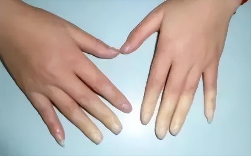 局限性和系统性硬皮病之间有什么联系? 哔哩哔哩