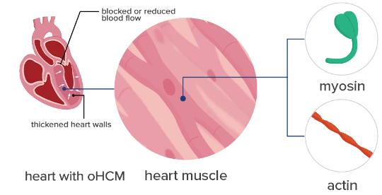 如何申请CAMZYOS的患者援助计划？ - 哔哩哔哩