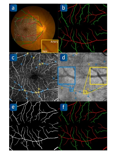 OCTA-500：用于光学相干断层扫描血管造影研究的视网膜数据集|文献速递 - 哔哩哔哩