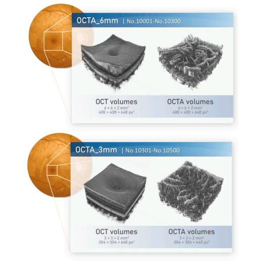 OCTA-500：用于光学相干断层扫描血管造影研究的视网膜数据集|文献速递 - 哔哩哔哩