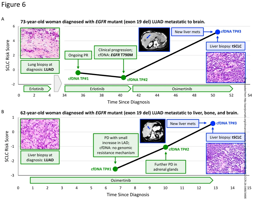 表观基因组cfDNA分析检测晚期EGFR突变肺腺癌患者的小细胞转化 | 肿瘤监测 - 哔哩哔哩