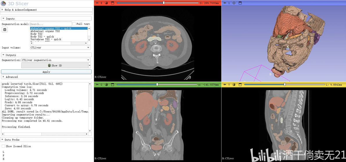 在3D Slicer中集成MONAI Auto3DSeg插件的经验分享(一) - 哔哩哔哩