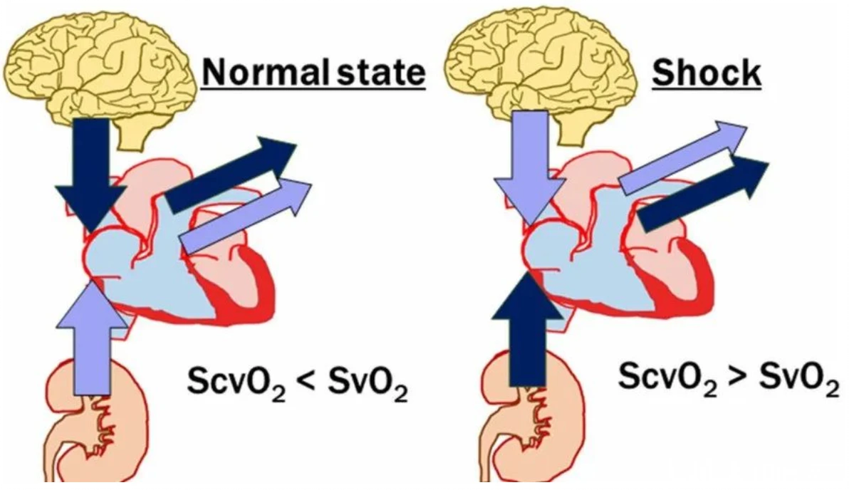 混血静脉血氧饱和度(SVO2)与中心静脉氧饱和度(ScVO2)的区别 - 哔哩哔哩