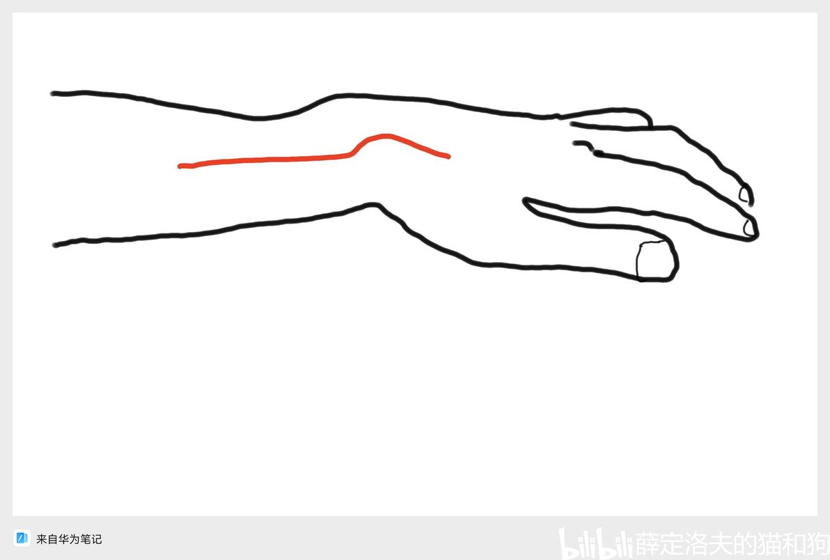 什么是Colles骨折的“餐叉样”畸形和“枪刺样”畸形 - 哔哩哔哩