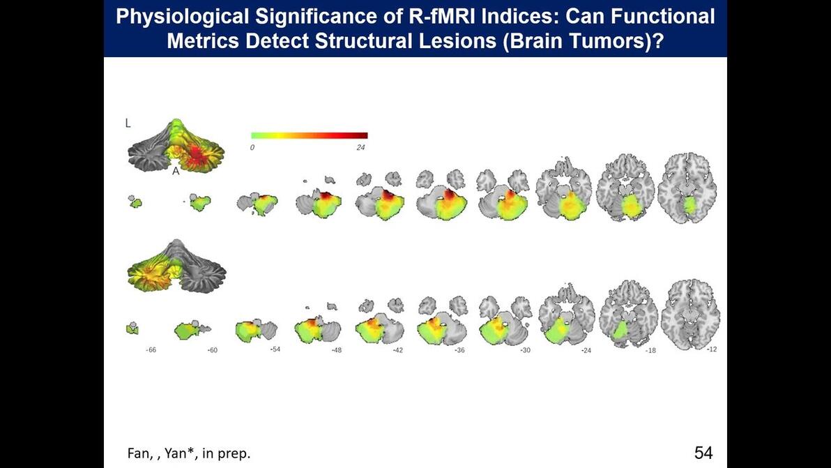 静息态功能磁共振成像(rs-fMRI)原理与数据分析,DPABI教程 - 哔哩哔哩