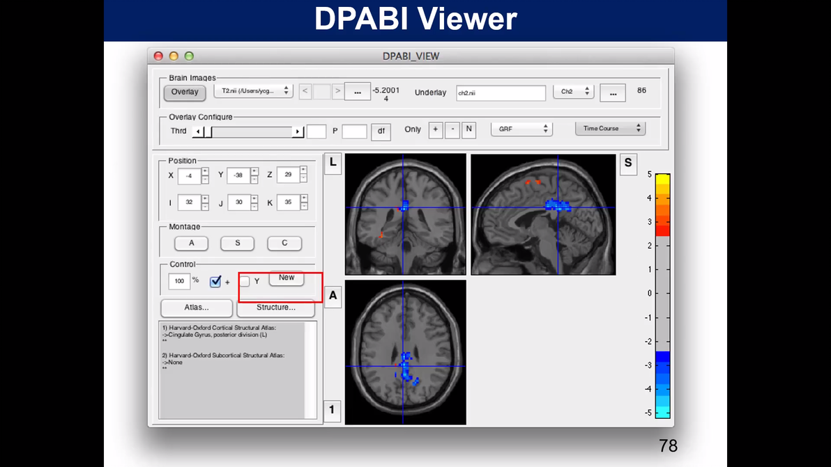 静息态功能磁共振成像(rs-fMRI)原理与数据分析,DPABI教程 - 哔哩哔哩